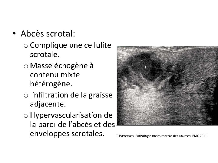 Echographie testiculaire aspect normal pathologique et variante de