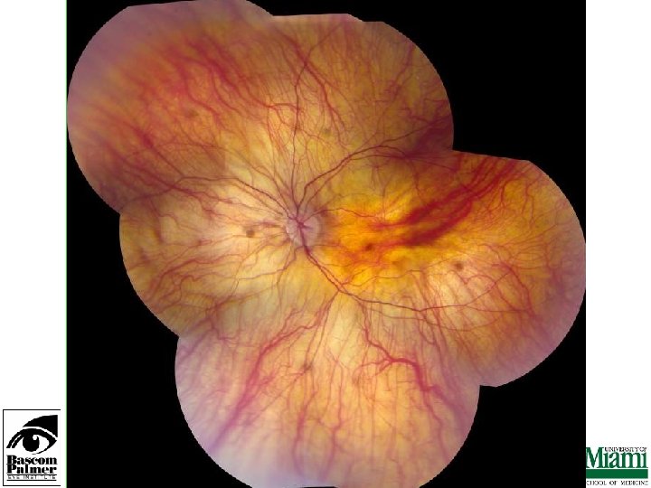 Bascom Palmer Eye Institute Grand Rounds Yousuf Qureshi