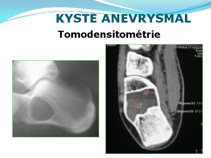 LES TUMEURS OSSEUSES PRIMITIVES DU CALCANEUM A Bouden