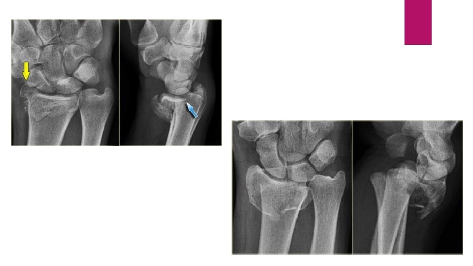 Imaging of Wrist DR AMITA HARSULE Basic Radiograph