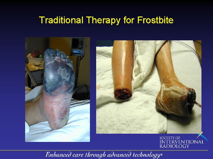 Thrombolytic Therapy for Limb Salvage in Severe Frostbite