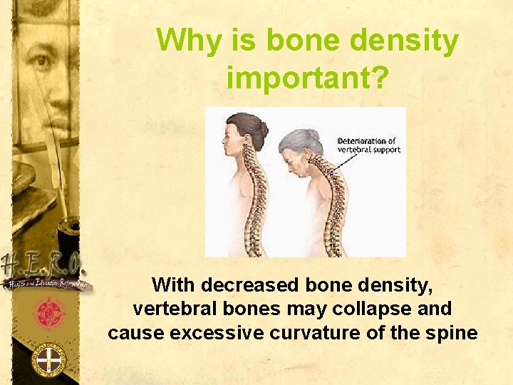OSTEOPOROSIS Should we be concerned What is osteoporosis