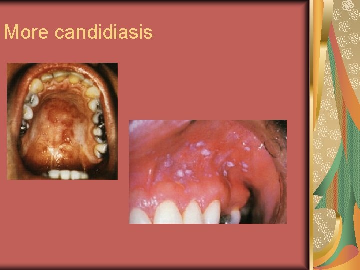 Chapter 4 Infectious Diseases Bacterial Infections Inflammatory and