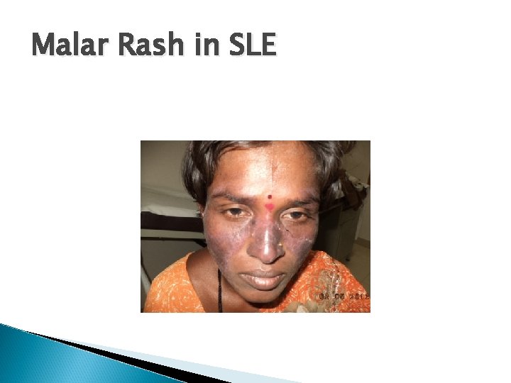 Systemic Lupus Erythematosus and Pregnancy An Overview Dr