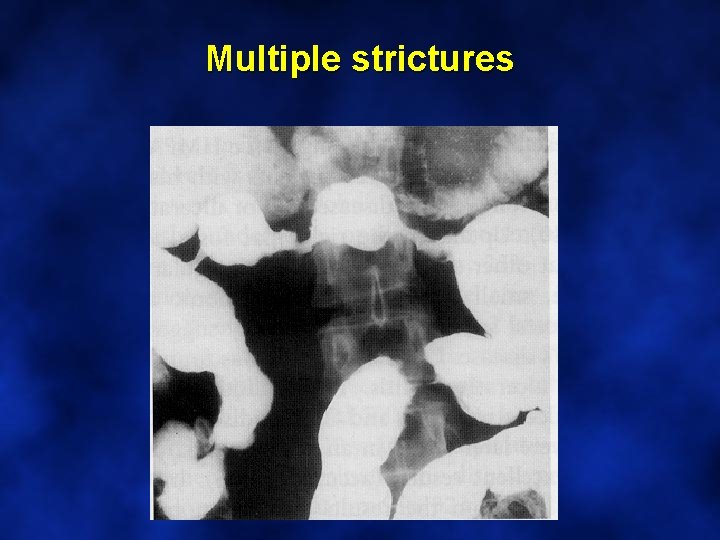 Dr Drelichman Surgical Techniques Part 2 Crohns Disease