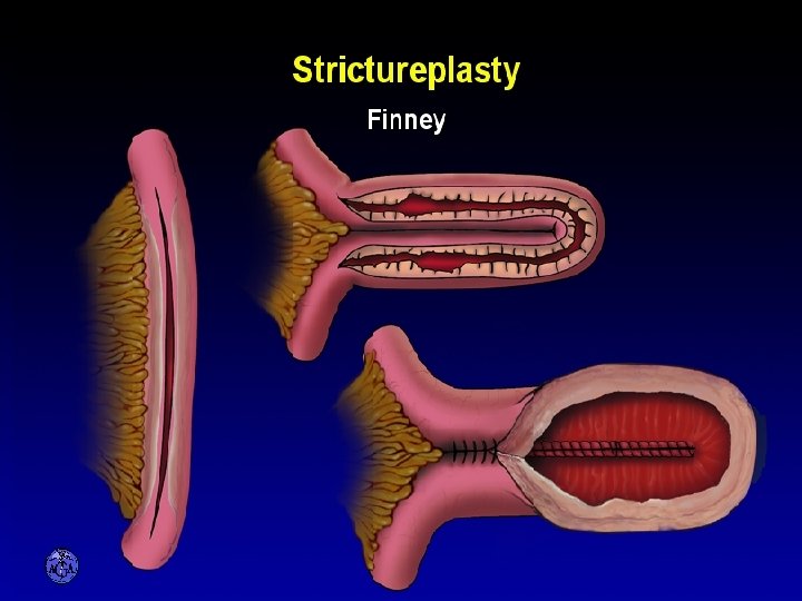 Dr Drelichman Surgical Techniques Part 2 Crohns Disease