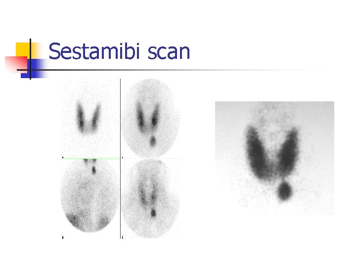 Calcium Metabolism and Parathyroid Disease James Mc Kinley