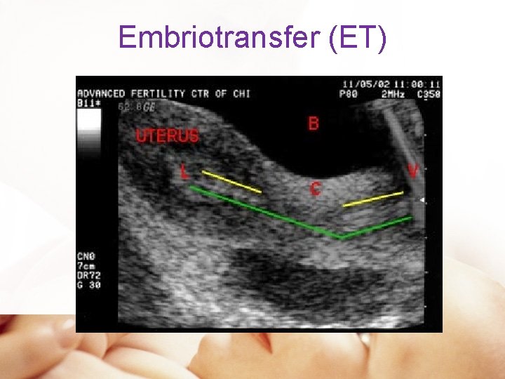 Assisted Reproductive Technologies ART Jelena Marui Assisted Reproductive