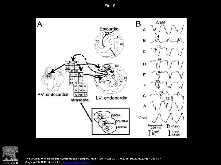 Mapping of septal ventricular tachycardia Clinical and experimental