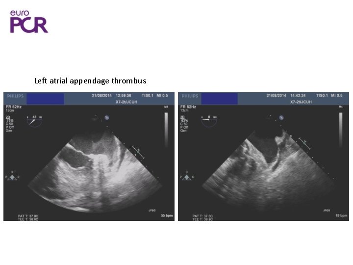 Left Atrial Appendage Thrombus in TAVI Prevalence clinical