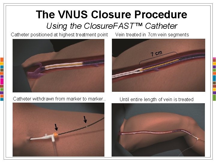 Venous Reflux Disease and Current Treatments VIVEK AGRAWAL