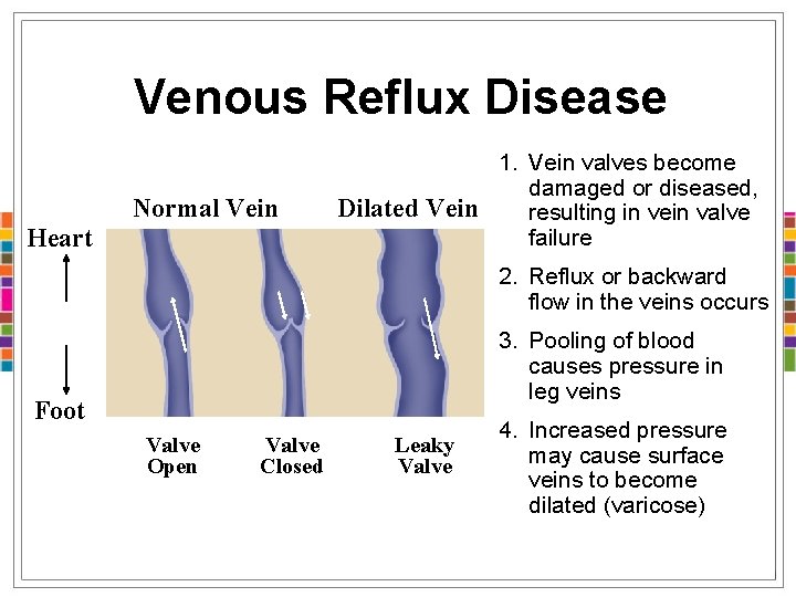 Venous Reflux Disease and Current Treatments VIVEK AGRAWAL