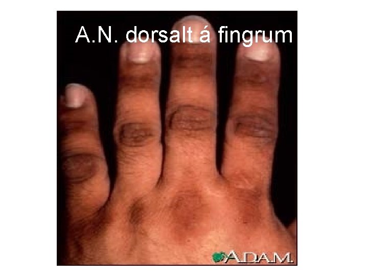 Acanthosis nigricans rvar Gunnarsson lknanemi Skilgreining Acanthosis ...