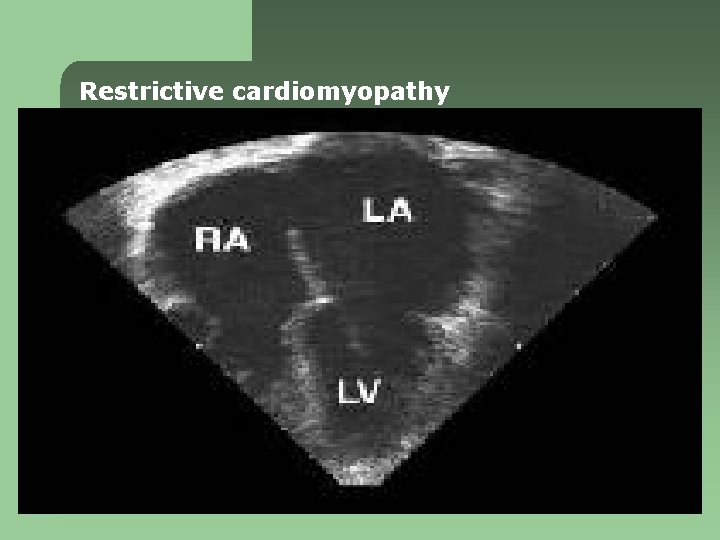 Cellular and molecular mechanisms Henning Bundgaard The Heart