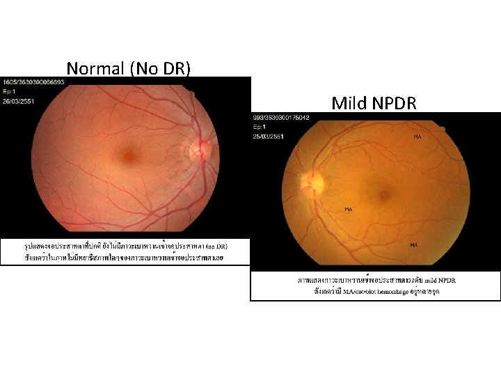 Diabetic Retinopathy DM 3 000 total 3 000