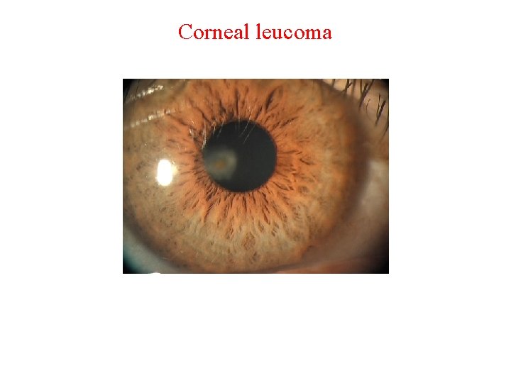 OPTO 4101 Refraction 1 Difficulties in retinoscopy Mohammed