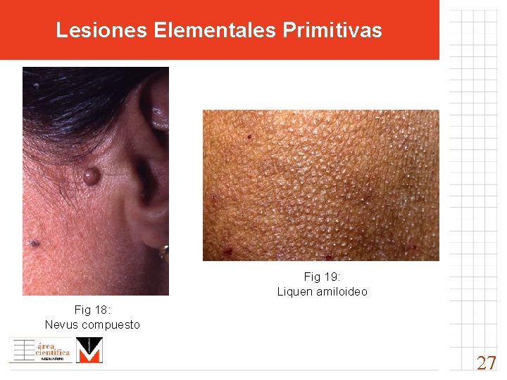 Lesiones Elementales Primitivas Fig 19 Liquen amiloideo Fig