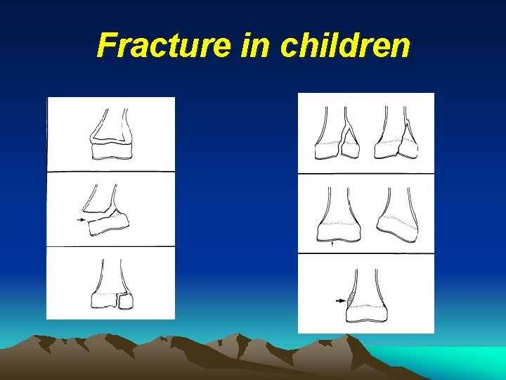 Principles Of Fractures2 DR FAWZI ALJASSIR MD MSc