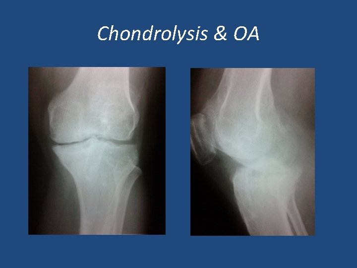 Infection After ACL Reconstruction H Makhmalbaf MD Consultant