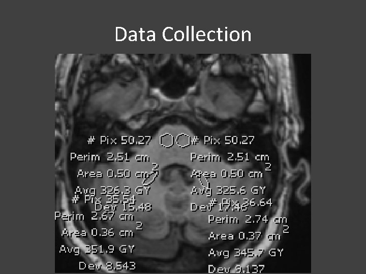 Gadobenate dimeglumine Multihance deposition in the dentate nucleus