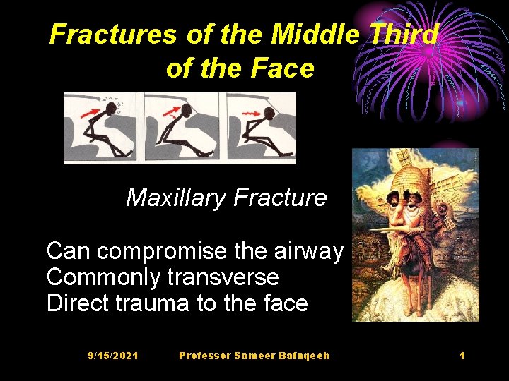 Fractures of the Middle Third of the Face