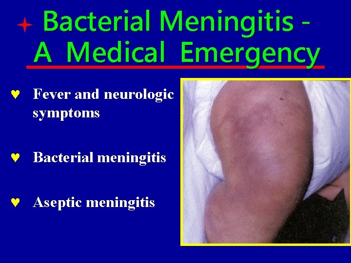 Bacterial Meningitis A Medical Emergency Swartz MN N