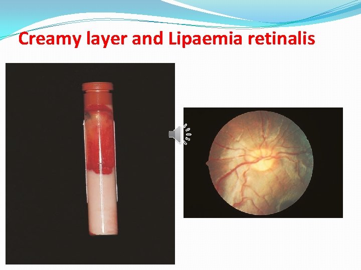 Disorders of lipid metabolism By Dr Qutaiba A