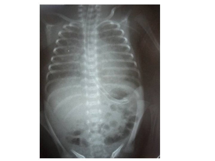 Caso Clnico Perfurao intestinal espontnea idioptica em um