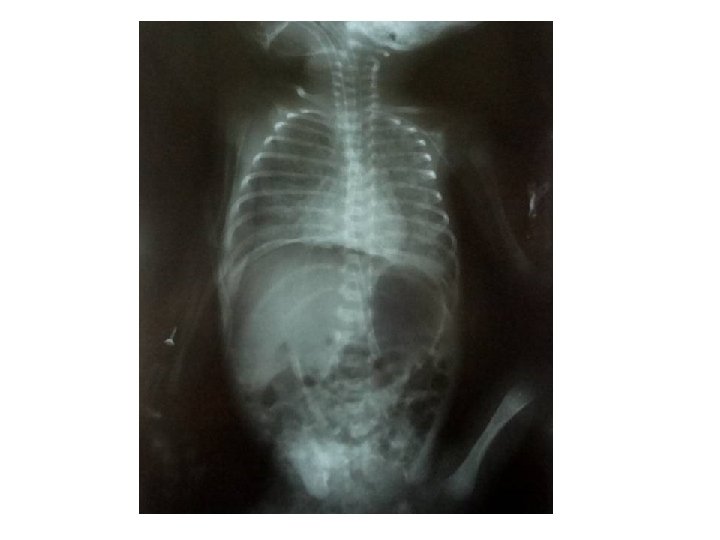 Caso Clnico Perfurao intestinal espontnea idioptica em um