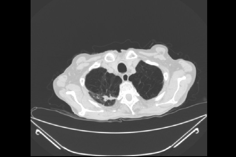 Broncopneumopatia Cronica Ostruttiva BPCO La BPCO una malattia