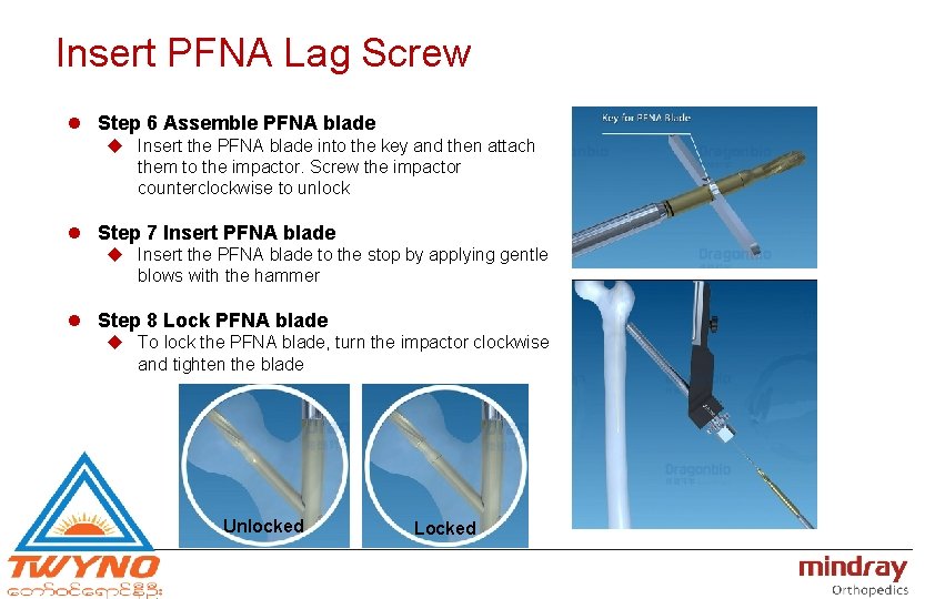 PFNAProximal Femoral Nail Antirotation Anatomy of Proximal Femur