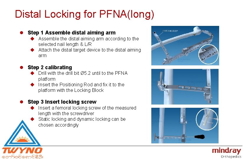 PFNAProximal Femoral Nail Antirotation Anatomy of Proximal Femur