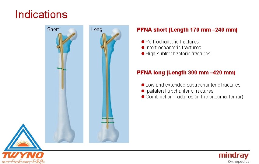 PFNAProximal Femoral Nail Antirotation Anatomy of Proximal Femur