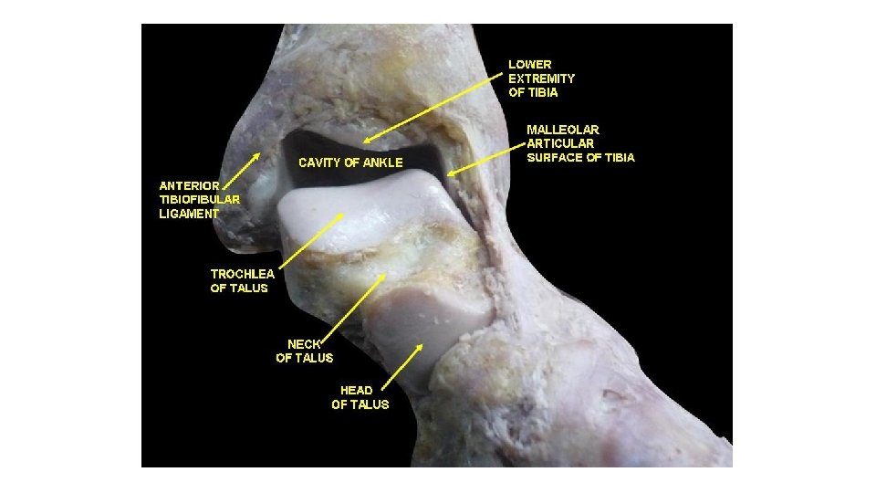 Ankle Joint talocruraltalotibialtibiotalartalar mortisetalar Jt RIMT ...