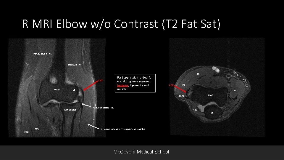 A Case of Lateral Epicondylitis Annika Medhus February