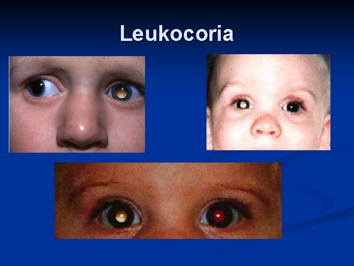 Eye Tumors Classification n Several Classifications 1 Benign