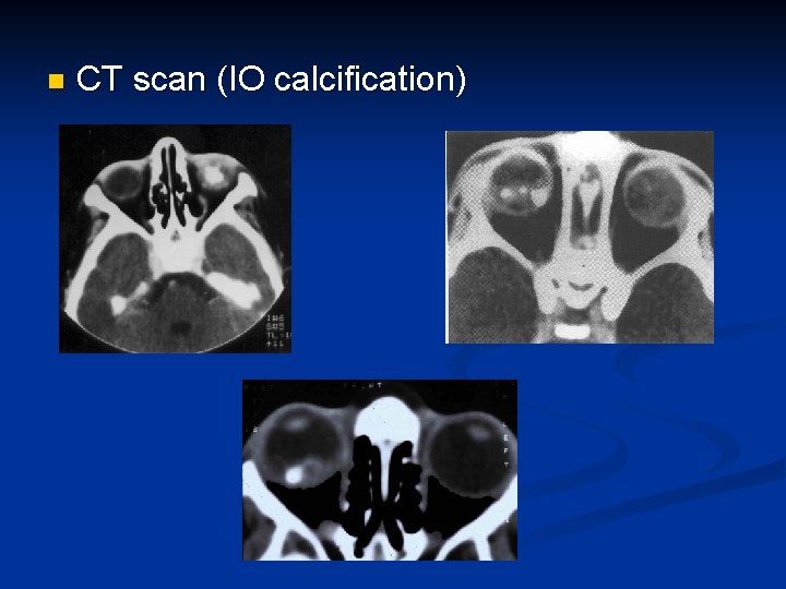 Eye Tumors Classification n Several Classifications 1 Benign