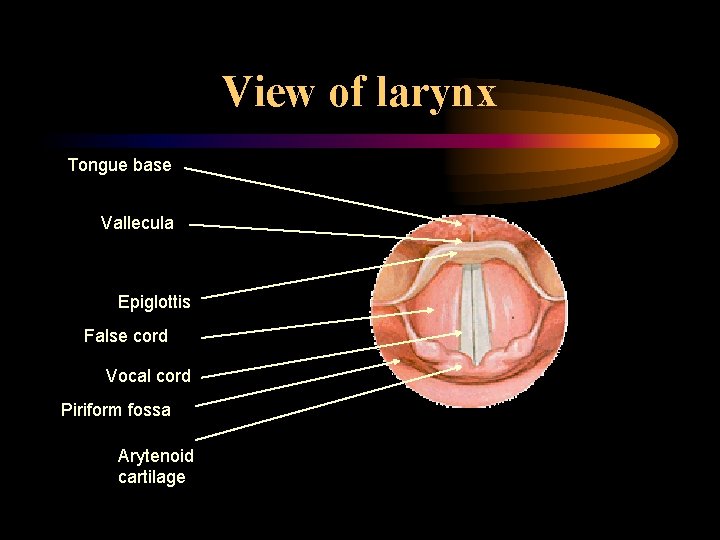Laryngeal webs Laryngeal cysts Subglottic stenosis signs Discharge
