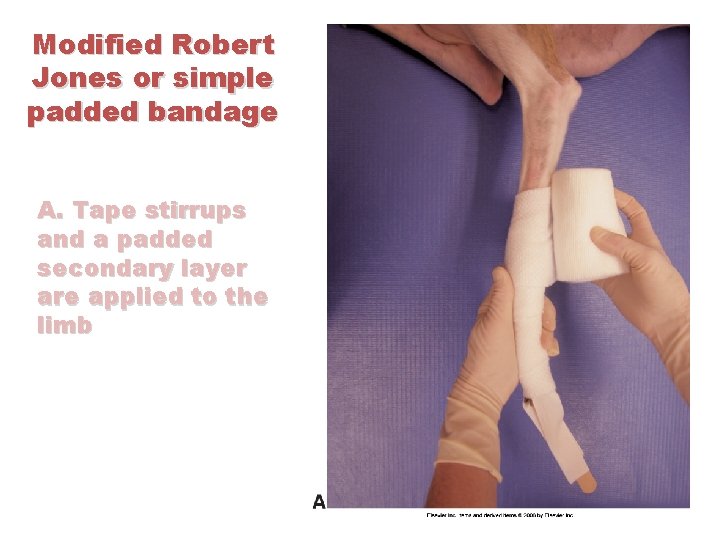 Bandage Types Robert Jones Bandage Used for temporary
