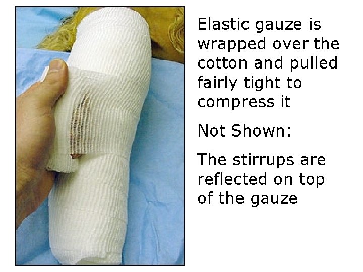 Bandage Types Robert Jones Bandage Used for temporary