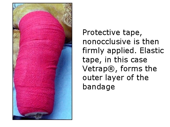 Bandage Types Robert Jones Bandage Used for temporary