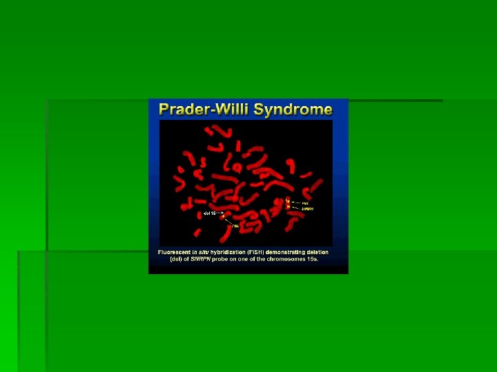 SINDROMI SINDROME DI ANGELMAN Nel 1965 Harry Angelman