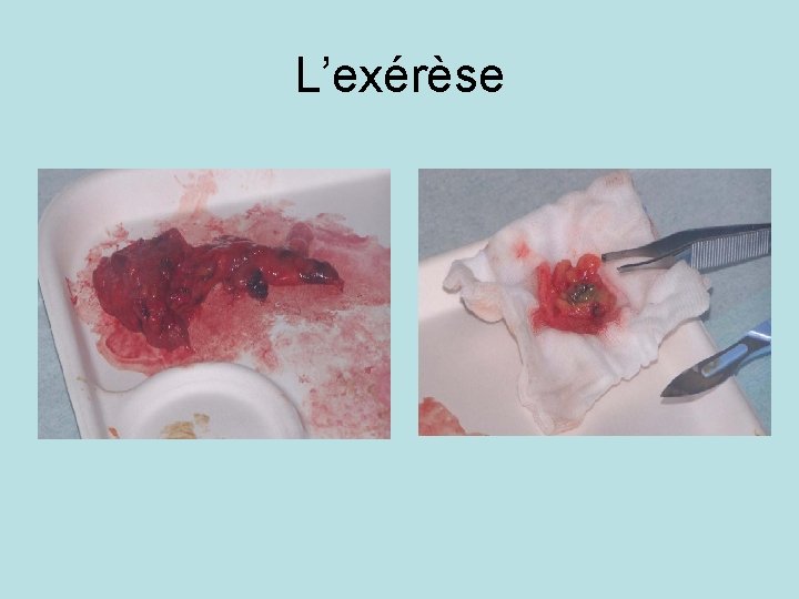 BASES DES CLASSIFICATIONS DE DIAGNOSTIC DES TUMEURS Dr