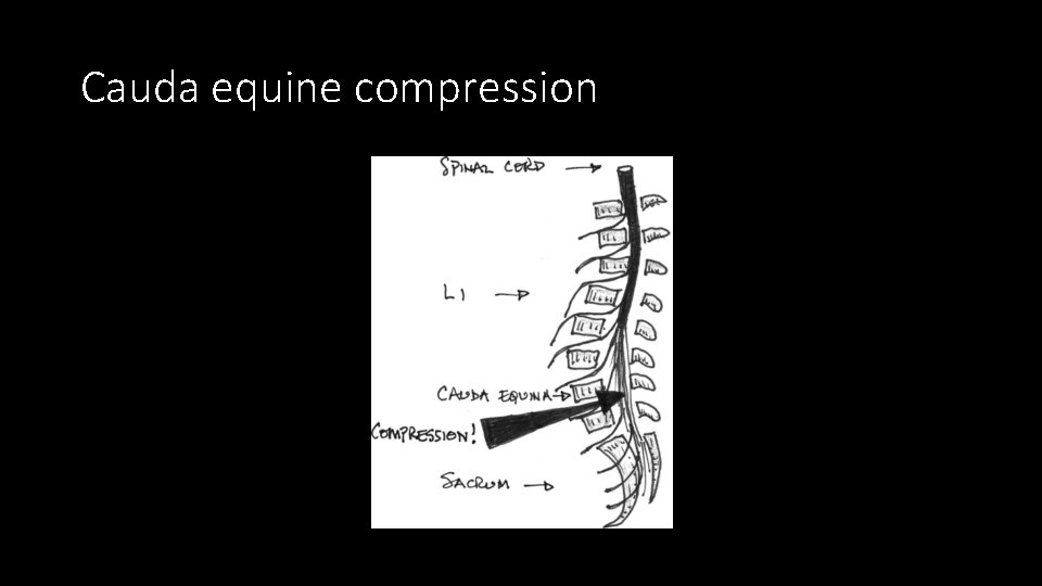 Spinal Trauma Types Cervical 40 Thoracic 10 Lumbar