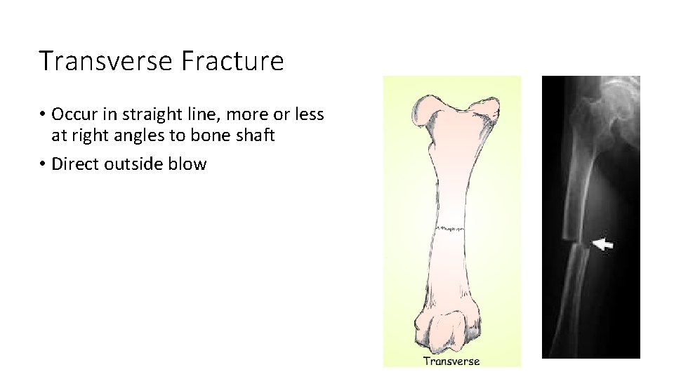 Skeletal Injuries Skeletal InjuriesFracture Fractures fx break in