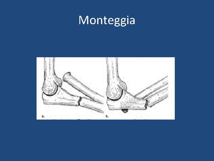 COMMON ADULTS FRACTURES OBJECTIVES CLAVICAL FRACTURE HUMERUS PROXIMAL