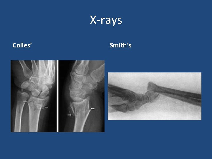 COMMON ADULTS FRACTURES OBJECTIVES CLAVICAL FRACTURE HUMERUS PROXIMAL
