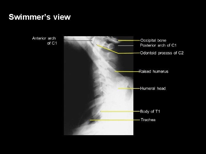 Imaging in spinal trauma Tips and special features