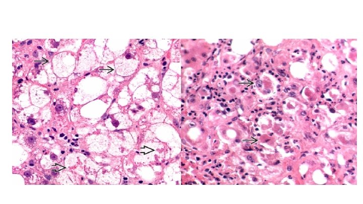 Liver Gallbladder Pathology II Ghadeer Hayel M D