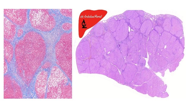 Liver Gallbladder Pathology II Ghadeer Hayel M D